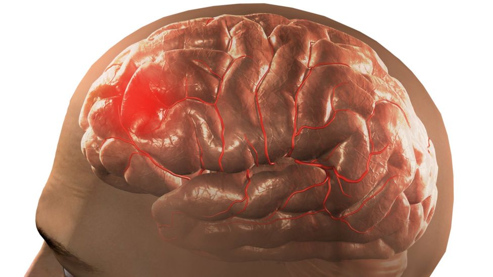 Clot-busting stroke drug safe, says expert review - BBC News