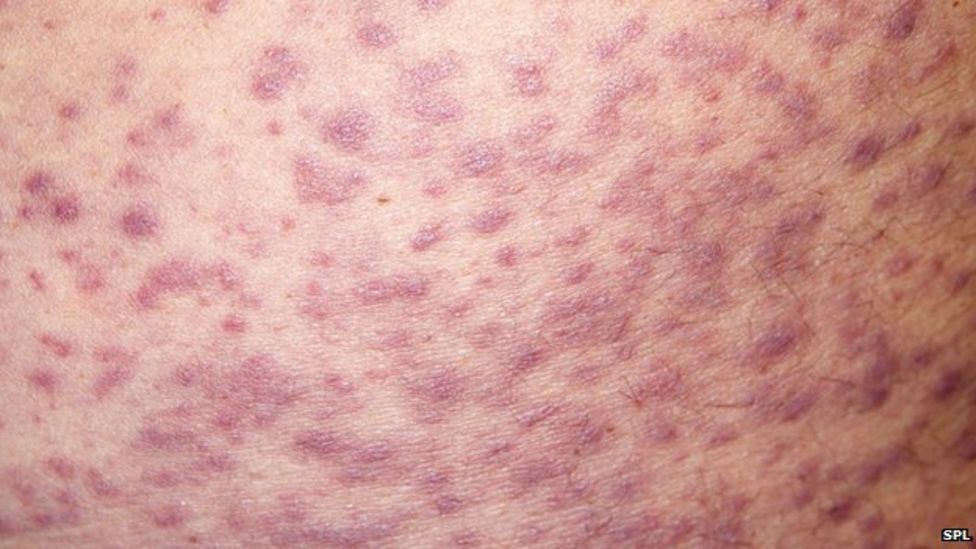 Doctors' allergy mistakes 'risking lives' - BBC News