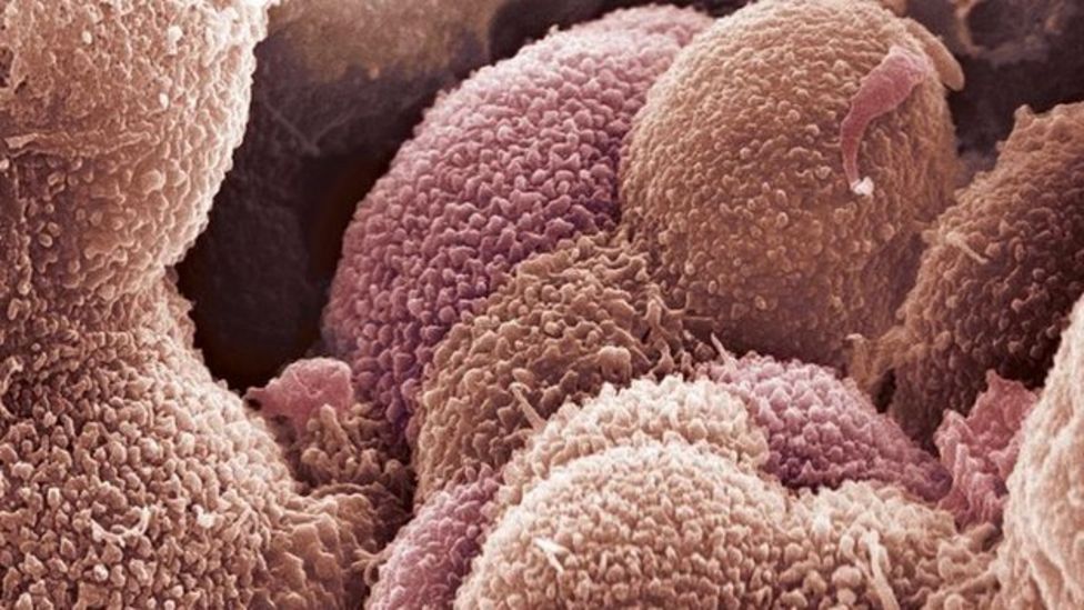 New test 'helps identify best ovarian cancer treatment' - BBC News