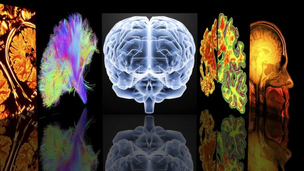 'It's just my brain is misbehaving' - BBC News