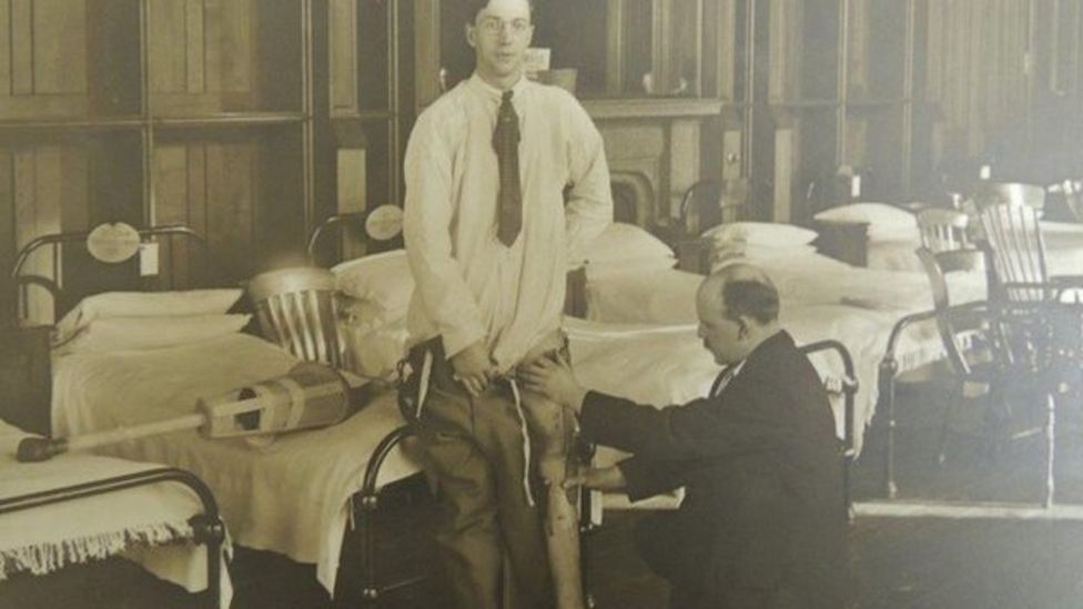 Amputation pain 'still a challenge' for medics - BBC News