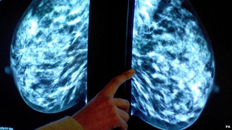 Breast cancer: The risks and treating the disease - BBC News