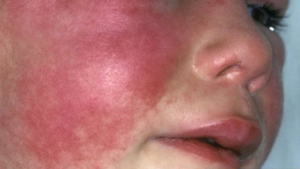 Scarlet fever cases hit 50-year high in England - BBC News
