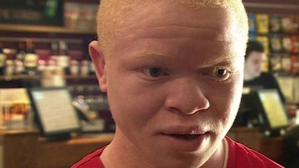 Living with albinism: 'I'm the one-in-18,000 in the UK' - BBC News