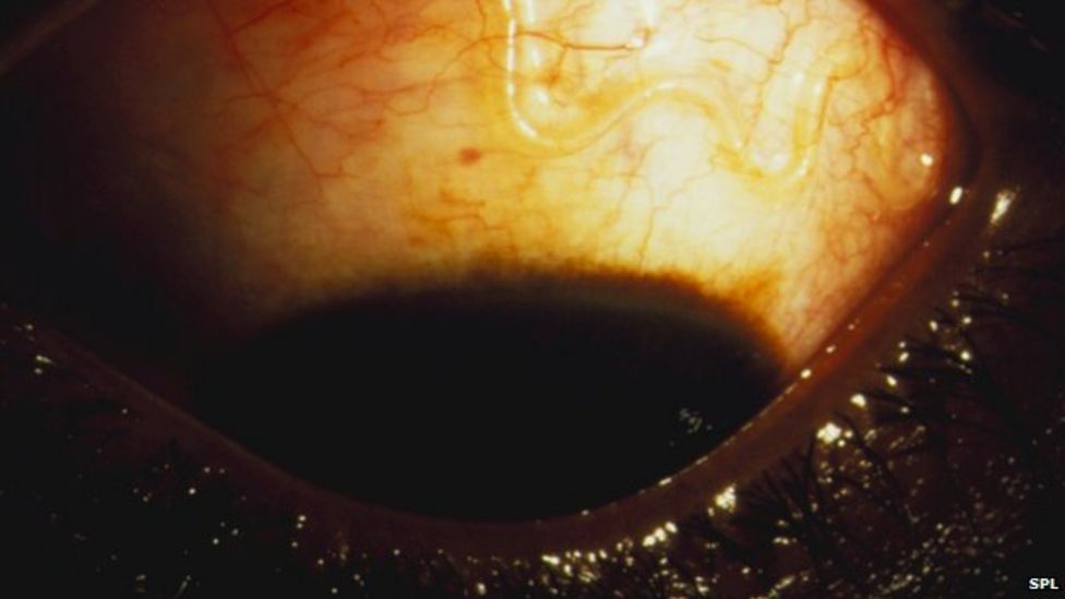 Smartphone 'scans' blood for parasites - BBC News