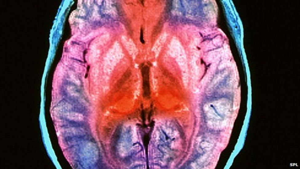 Scientists find CJD resistance gene - BBC News