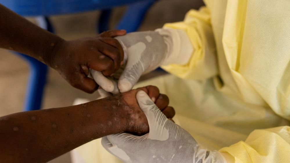 First case of more dangerous mpox found outside Africa - BBC News