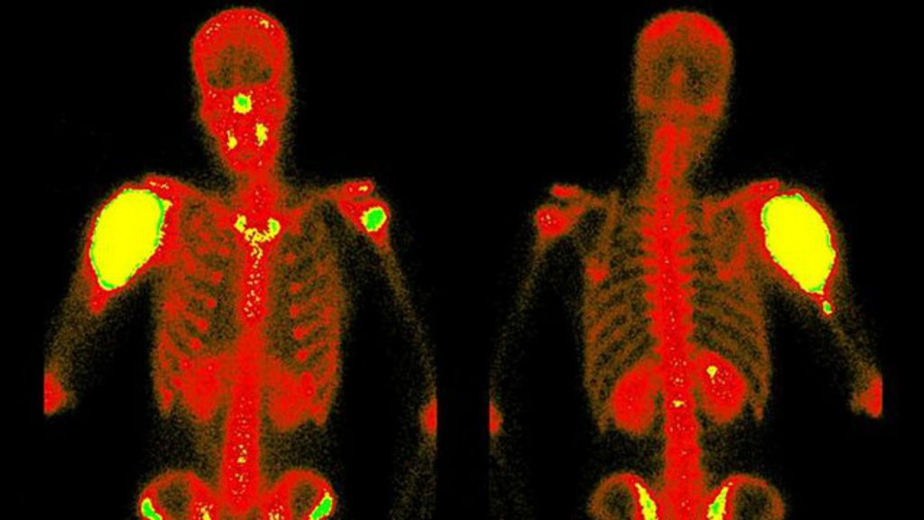 Tecnecio: el elemento que puede hacer brillar los huesos - BBC Mundo