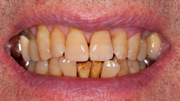 BBC - Earth - How our ancestors drilled rotten teeth